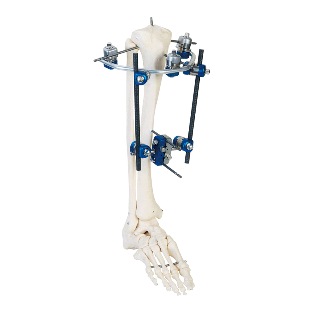 Proximal tibia external fixator from China manufacturer - Guli